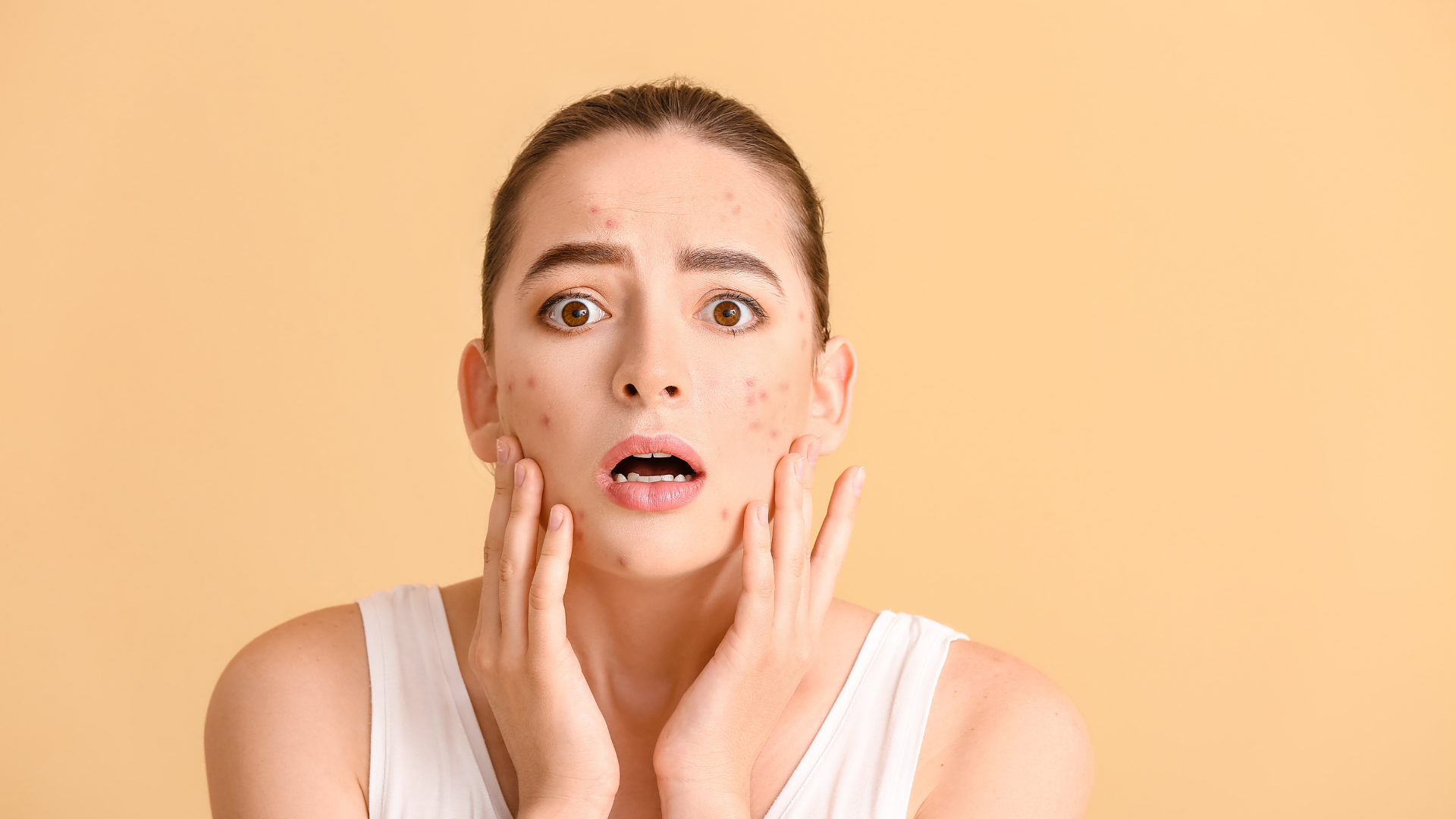 Beyond the Blemish: Understanding and Managing Cystic Acne – Skin ...